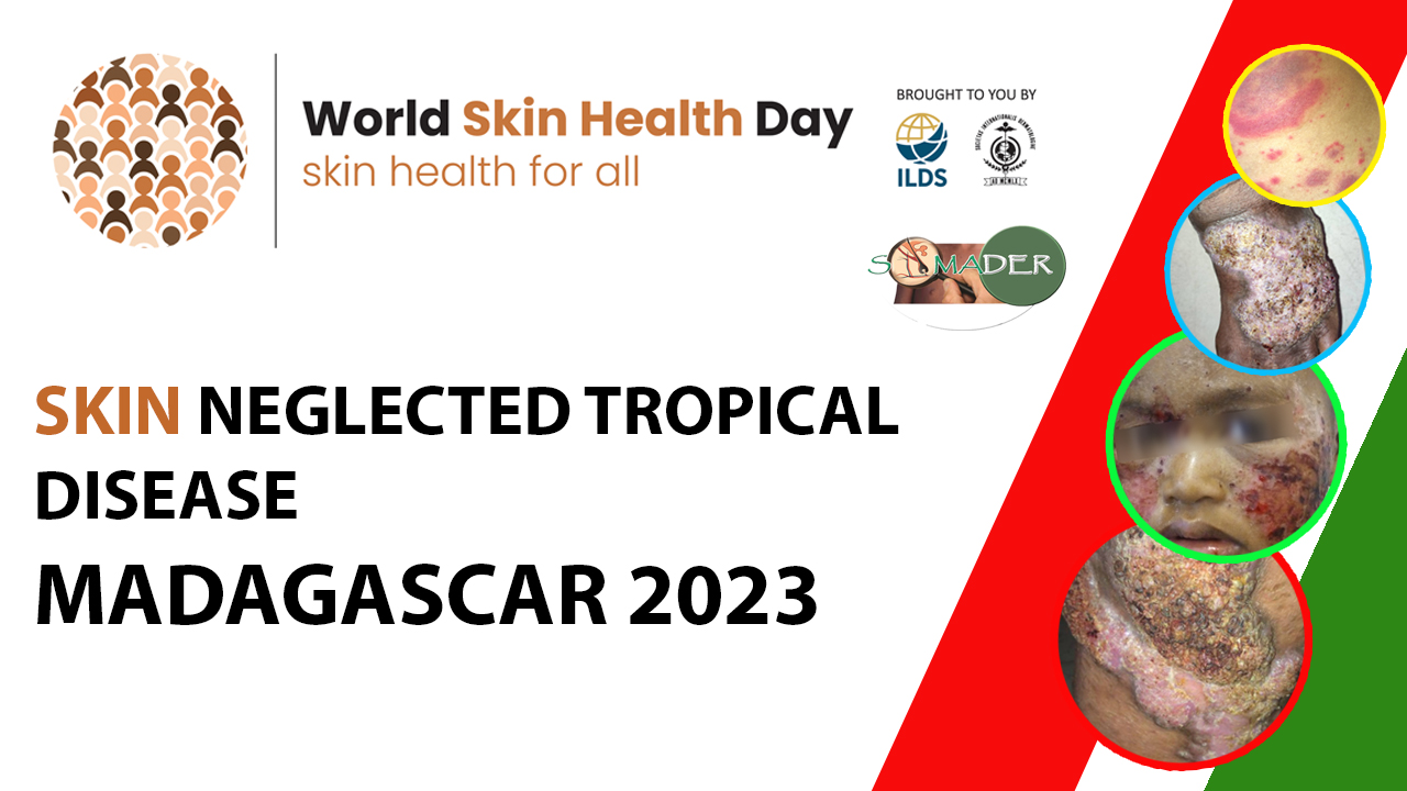World Skin Health Day (Madagascar, Tunisia): Skin Neglected Tropical ...