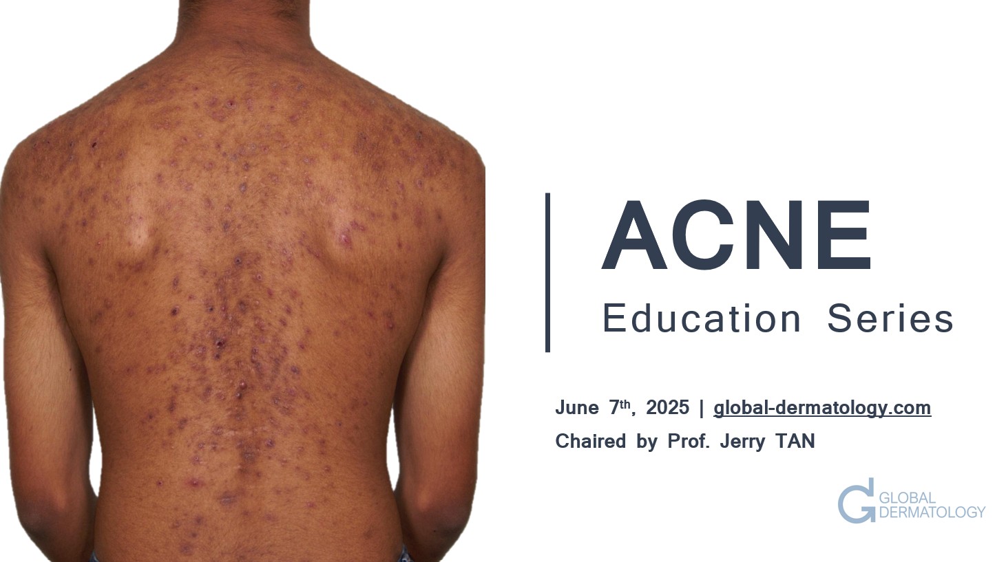 ACNE | Global Education Day 2025 - Event - Global Dermatology