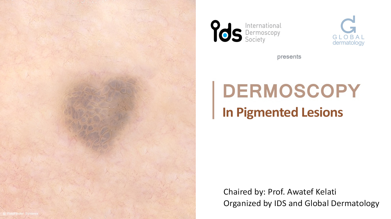 Dermoscopy in Pigmented lesions - Course - Global Dermatology